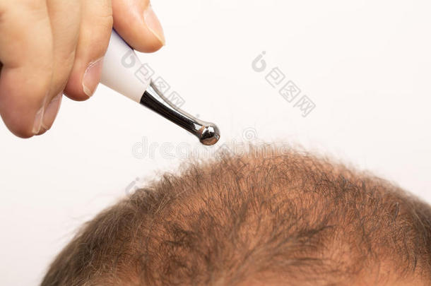成人脱发秃头的打捆秃顶图片 包图网企业站